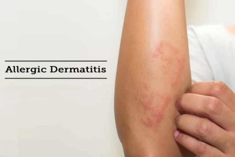 Allergic Dermatitis: Tips for Identifying and Avoiding Skin Irritants
