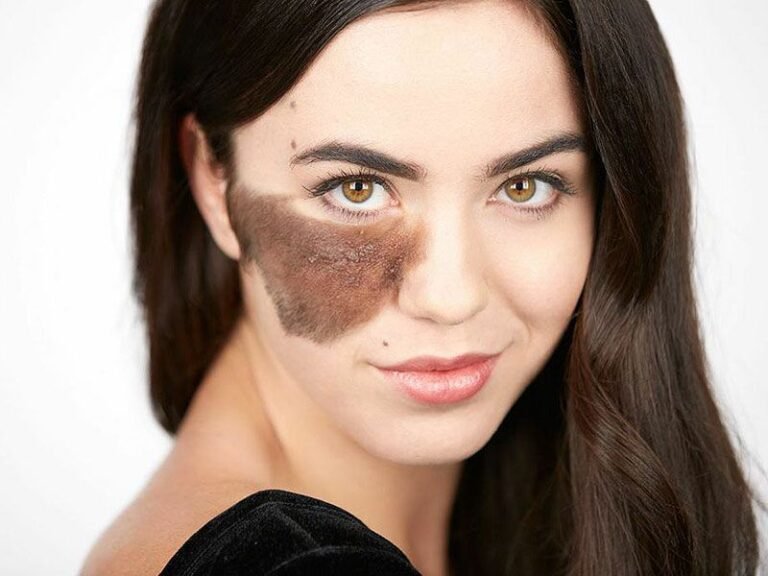 Birth Marks Removal - Athena Skin Hair & Dental Clinic